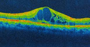 Macular Edema Treatment in Eluru | Vijaya Eye Hospital